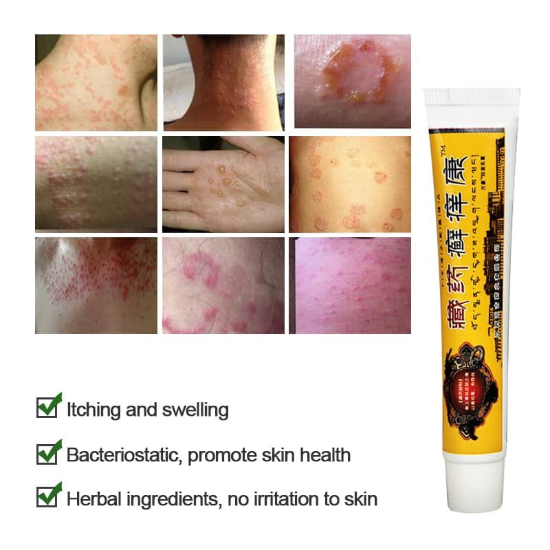 Psoriasis Antipruritic Ointment Herbal Antibacterial Cream Treat Eczema