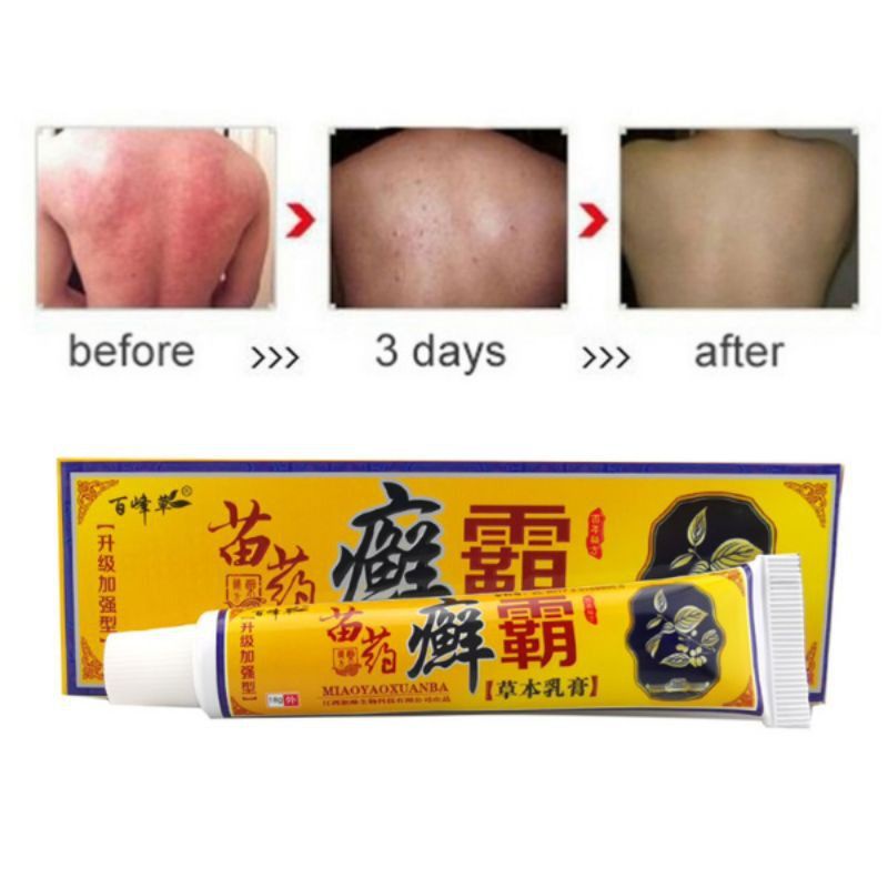 Ubat Gatal Kulit Original Eczema Cream Herbal Ubat Gatal China ...