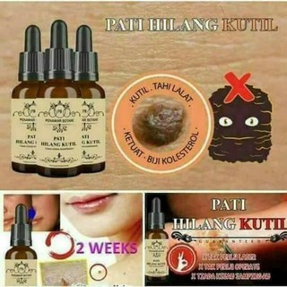 RASH UBAT BUANG KUTIL/PATI HILANG KUTIL | Shopee Malaysia