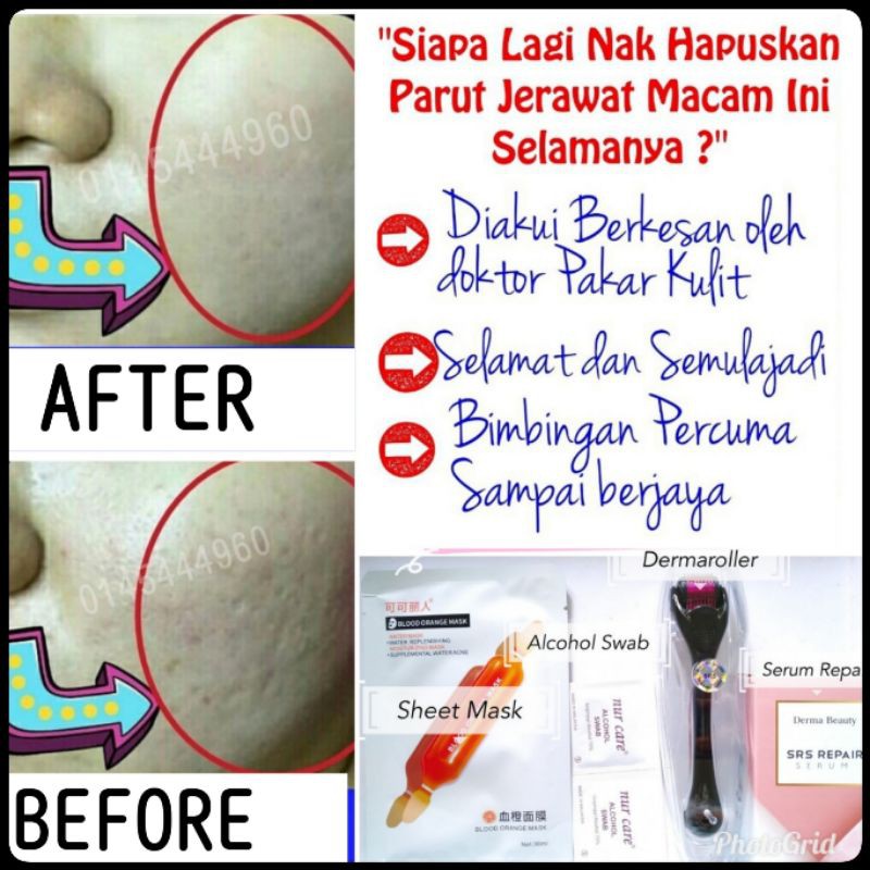 PARUT JERAWAT SET DERMAROLLER SERUM PARUT JERAWAT PARUT BERLUBANG ...