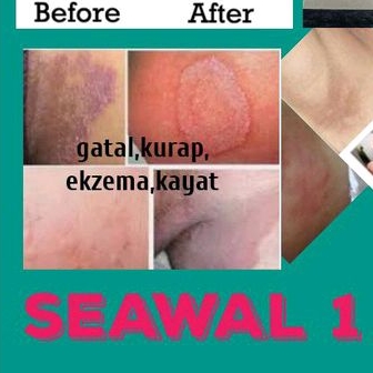 ready stok,hilang gatal berkesan,EKZEMA,KURAP ,PANAU,KUDIS,RUAM-RUAM ...