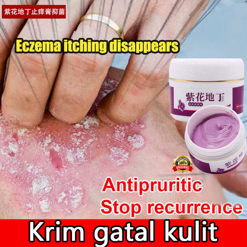 Krim gatal kulit Ubat gatal kulit 30g Antibacterial anti-itch herbal ...