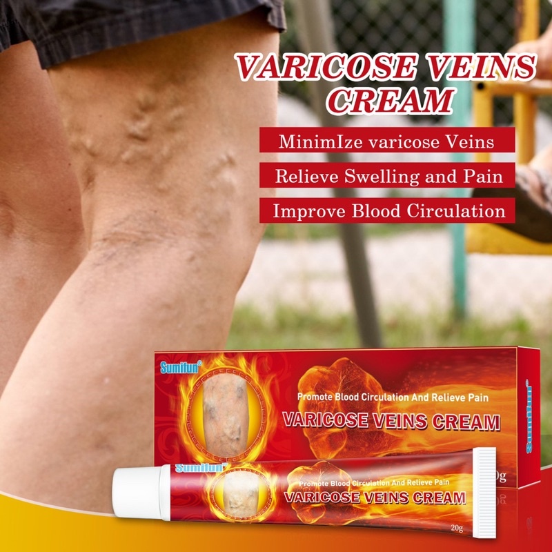 Urat kaki timbul Varicose veins pain Sumifun ORIGINAL 20g | Shopee Malaysia