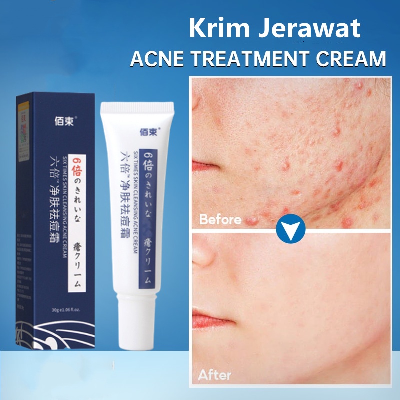 Acne removing cream Repair Acne Marks And Acne Pits To Fade Acne Scars ...