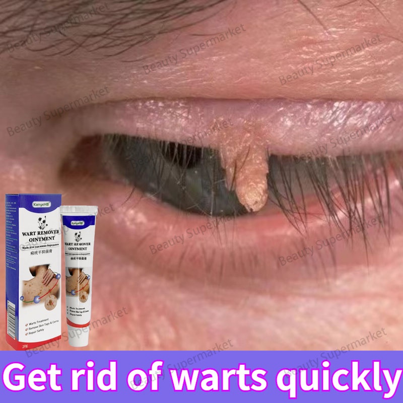 wart removal Skin tag remover cream Wart Removal Ointment Ubat Ketuat ...