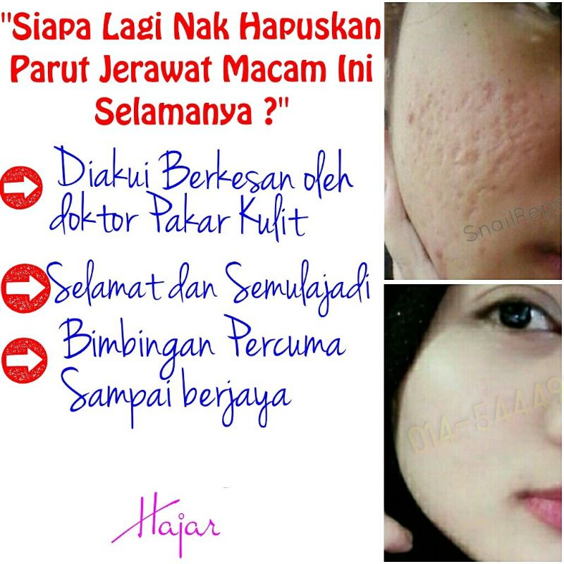 PARUT JERAWAT SET DERMAROLLER SERUM PARUT JERAWAT PARUT BERLUBANG ...