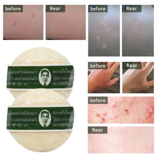 Sabun Gatal Eczema/ Psoriasis Thai/ Kurap Kudis Panau/ Masalah Kulit ...