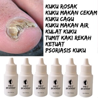 Ubat Kuku Kaki Tangan Nail Treatment Kuku Cekam Cagu Nail Fungus Foot ...