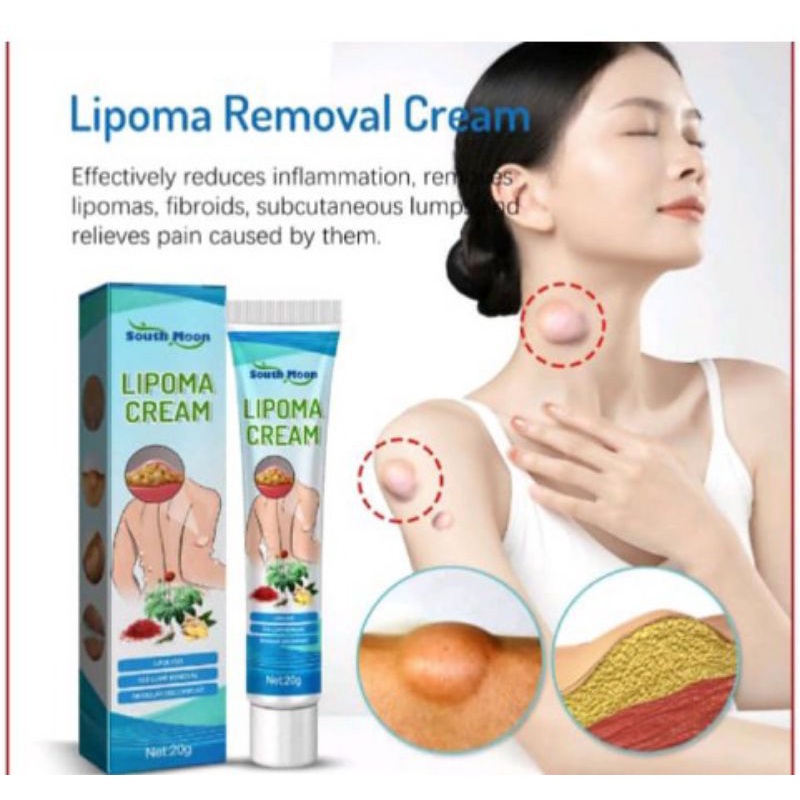 20g Lipoma Ointment Treatment Cream Natural Plant Fat | Shopee Malaysia