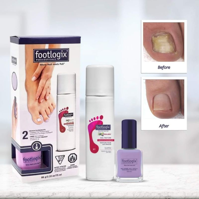 [READY STOCK] FOOTLOGIX Nail Tincture Anti Fungus for Nail 75g (With ...