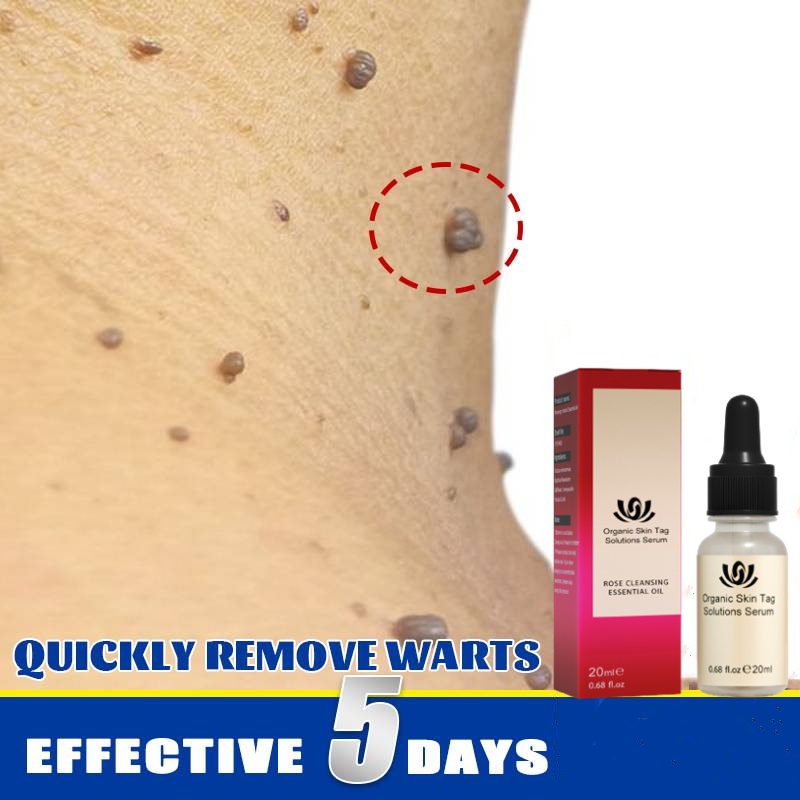 Ubat Kutil Tahi Lalat Ketuat Dan Biji Kolesterol Skin Tag Remover Mole ...