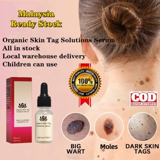 Ubat Kutil Tahi Lalat Ketuat Dan Biji Kolesterol Skin Tag Remover Mole ...