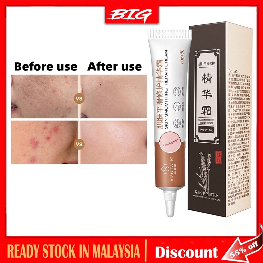 Scar Care Hilangkan Parut Ubat Hilangkan Parut Scar Remover Scar Cream ...